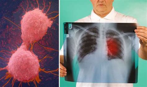 Gps Diagnosis Of Lung Cancer Questioned After Third Die Within 90 Days Uk