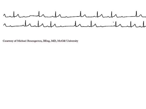 Ecg Lecture Sinus Arrest Sinoatrial Exit Block Av Block And Escape Rhythms Ppt Heart And