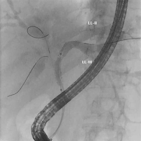 Fluoroscopic Image Showing Bismuth Corlette Type Iv Perihilar