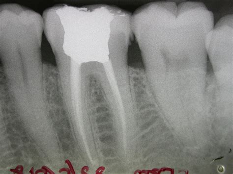 Root Canal Yap And Associates Dental Surgery Kuala Lumpur Malaysia