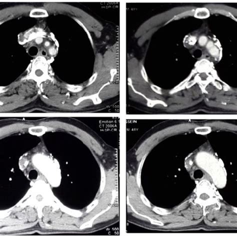 Chest Ct Scan With Iv Contrast Shows Irregular Filling Defect And