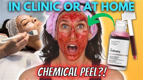 Chemical Peels 3 Surprising Things That Happen When You Get Chemical