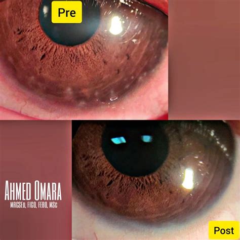 Ahmed Omara On Linkedin Marginal Keratitis Staph Hypersensitivity