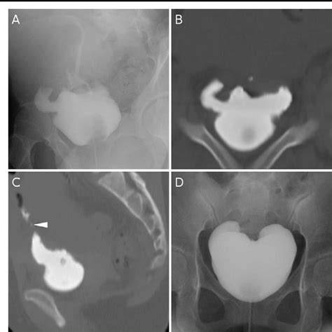 Urinary Bladder Fistula Semantic Scholar