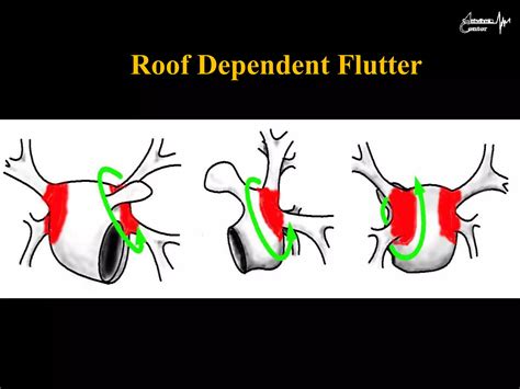 Ablation Of Atypical Flutter Pptx
