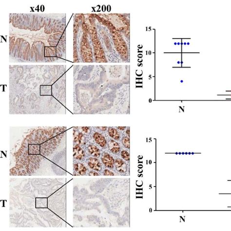 Analysis Of Clca4 Protein Expression In Crc Through Ihc Based Tma