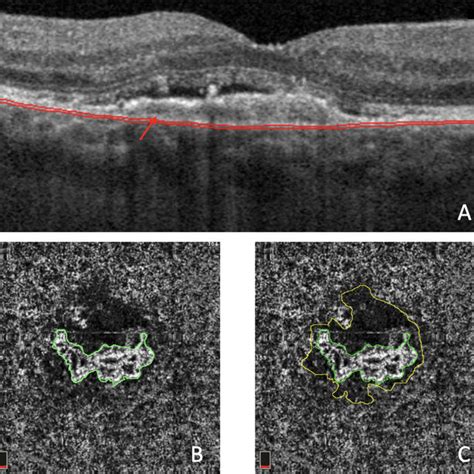 A Structural OCT B Scan Displays The Corresponding CC Segmentation