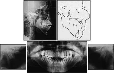 Pretreatment Lateral Cephalometric Radiograph And Tracing Panoramic