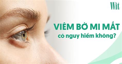 Viêm Bờ Mi Mắt Nguyên Nhân Dấu Hiệu Và Cách điều Trị Wit