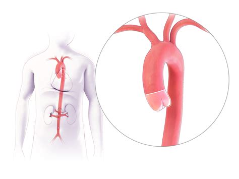 Aortic Root Surgery At Emory Heart And Vascular