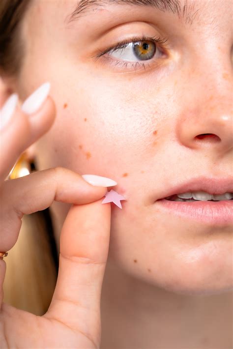 How To Correctly Use A Pimple Patch For Breakouts