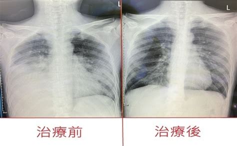 酒精惹的禍！患新冠重症插管難以麻醉下場曝光 觀傳媒