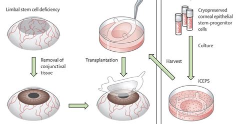 2025 줄기세포 파킨슨·당뇨병·뇌전증 줄기세포로 치료 길 열린다