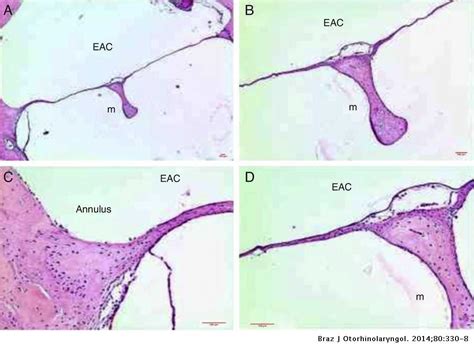 Spontaneous Healing Of The Tympanic Membrane After Traumatic