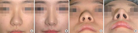 Rinoplastia No Nariz De Batata