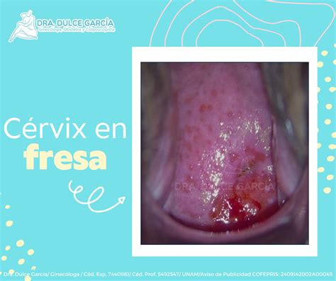 Dra. - CASO CLÍNICO 👩Acude al consultorio paciente la cual refería secreción vaginal blanco ...