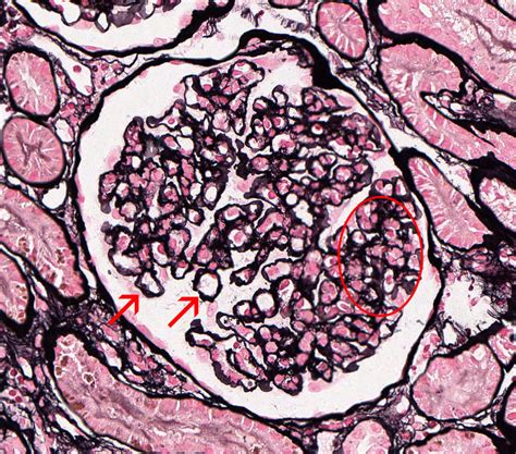Mesangial Proliferative Glomerulonephritis