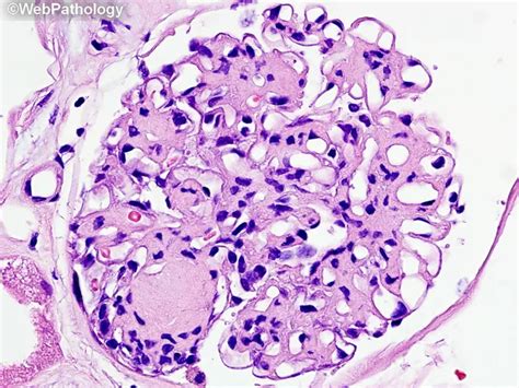Diabetic Nephropathy Nodular Glomerulosclerosis