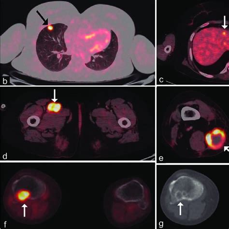 Characteristics Of Melanoma Patients With Distant Metastases Download Scientific Diagram
