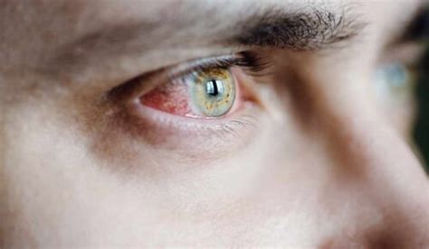 Pink Eye Conjunctivitis What Is Symptoms And How To Prevent