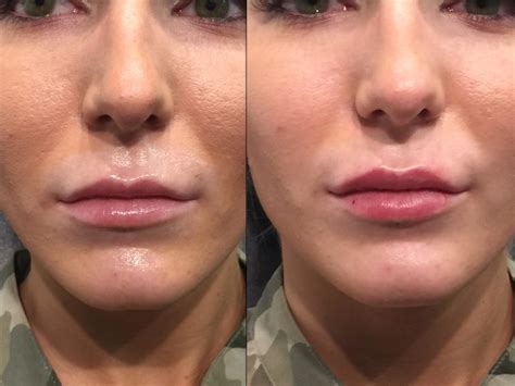 My Restylane Lip Injections Med Spa Reviews