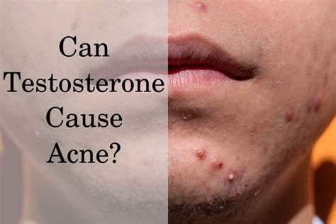 Is Testosterone A Cause Of Your Acne Hrtguru