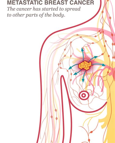 How Does Cancer Spread