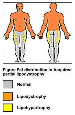 Acquired Partial Lipodystrophy Clinical Presentation History Physical