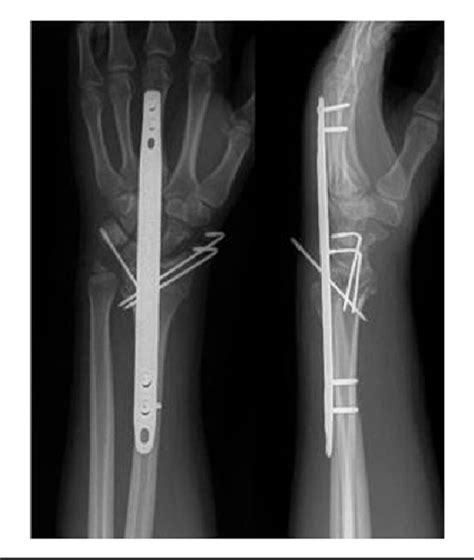 78 Dorsal Plate Fixation And Dorsal Distraction Bridg