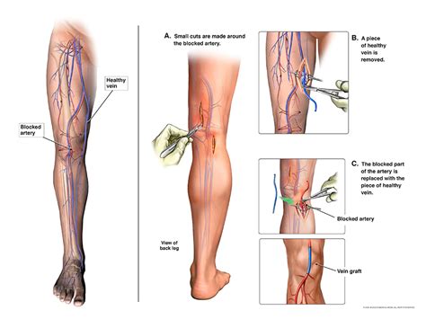 Peripheral Artery Disease Treatment Nhlbi Nih