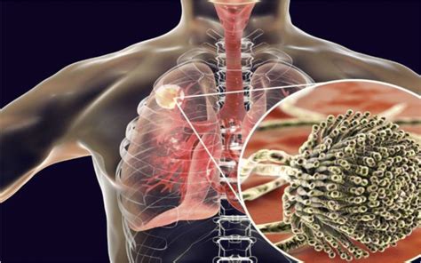Aspergillosis Fungal Present In Human Lung 5 Download Scientific