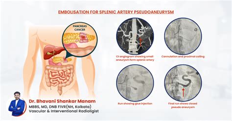 Splenic Artery Embolization In Pancreatitis A Vital Intervention