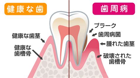 歯周病について｜楠原デンタルクリニック