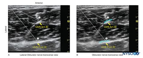 Ultrasound Guided Obturator Nerve Block Nysora