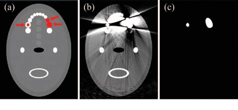 Figure 1 From A Hybrid Metal Artifact Reduction Algorithm For X Ray Ct