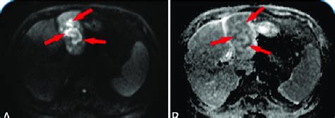A B Diffusion Weighted Images And Apparent Diffusion Coefficient Download Scientific Diagram