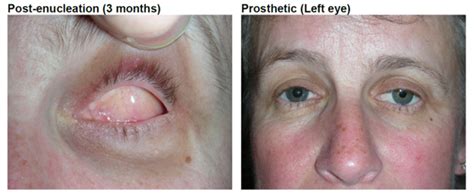 Evisceration And Enucleation Vision And Eye Health