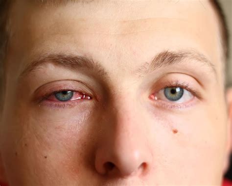 article 3 things you should avoid doing when having conjunctivitis