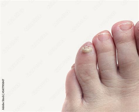White Toe Fungus
