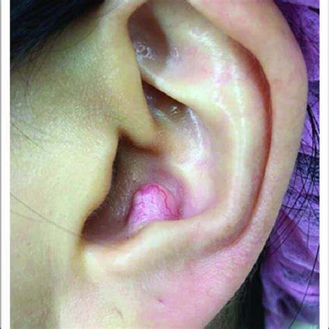 The Well Circumscribed Auricular Nodule Is Elastic Tender And