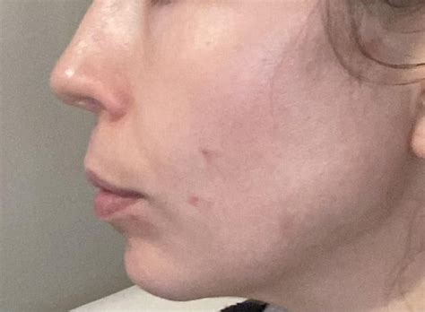 Will Sliding Genioplasty Help Rjawsurgery