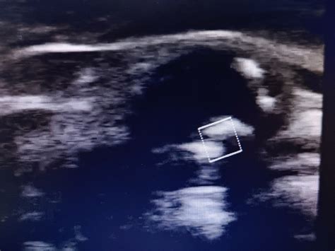 Cypress Early Detection Cardiovascular Imaging Program Cypress Heart Health Early Detection