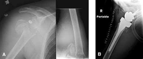 Figure 1 From Three And Four Part Proximal Humerus Fractures Evolution To Operative Care
