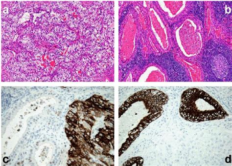 A Solid Component Consisting Of Atypical Cells With Irregular Nuclei