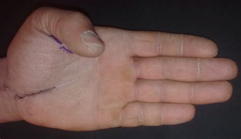 Two Weeks Follow Up Note The Capability Of The Thumb To Flex The IP Download Scientific