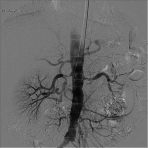 Renal Artery Stenosis Radiology Reference Article