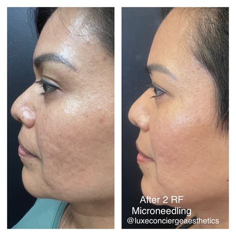 Pixel8 Rf Microneedling In Miami Luxe Concierge Aesthetics