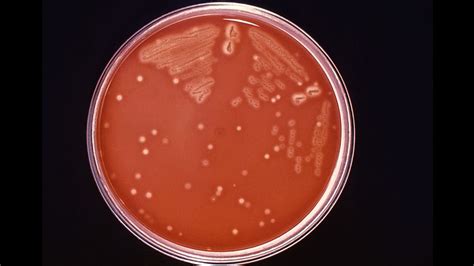 Cdc Warns Doctors To Be On Alert For Cases Of Flesh Eating Bacteria