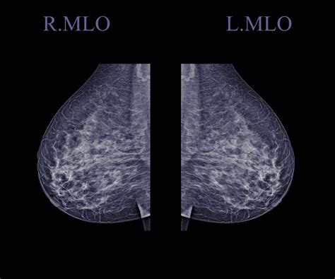 Dense Breast Tissue And Cancer Risk What The New Fda Rule Means Womans World