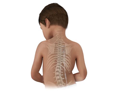 Response™ Rib And Pelvic System Orthopediatrics